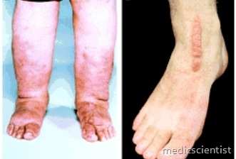 Myxedema coma Diagnosis and Treatment - MedicScientist